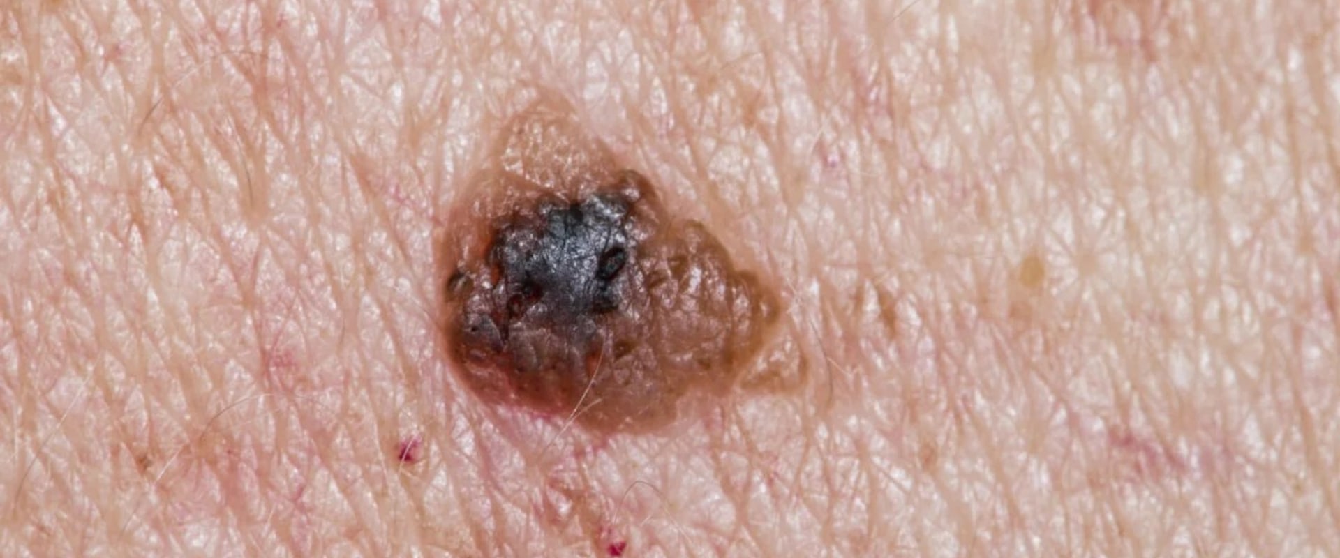 Understanding the Risk Factors of Melanoma Skin Cancer