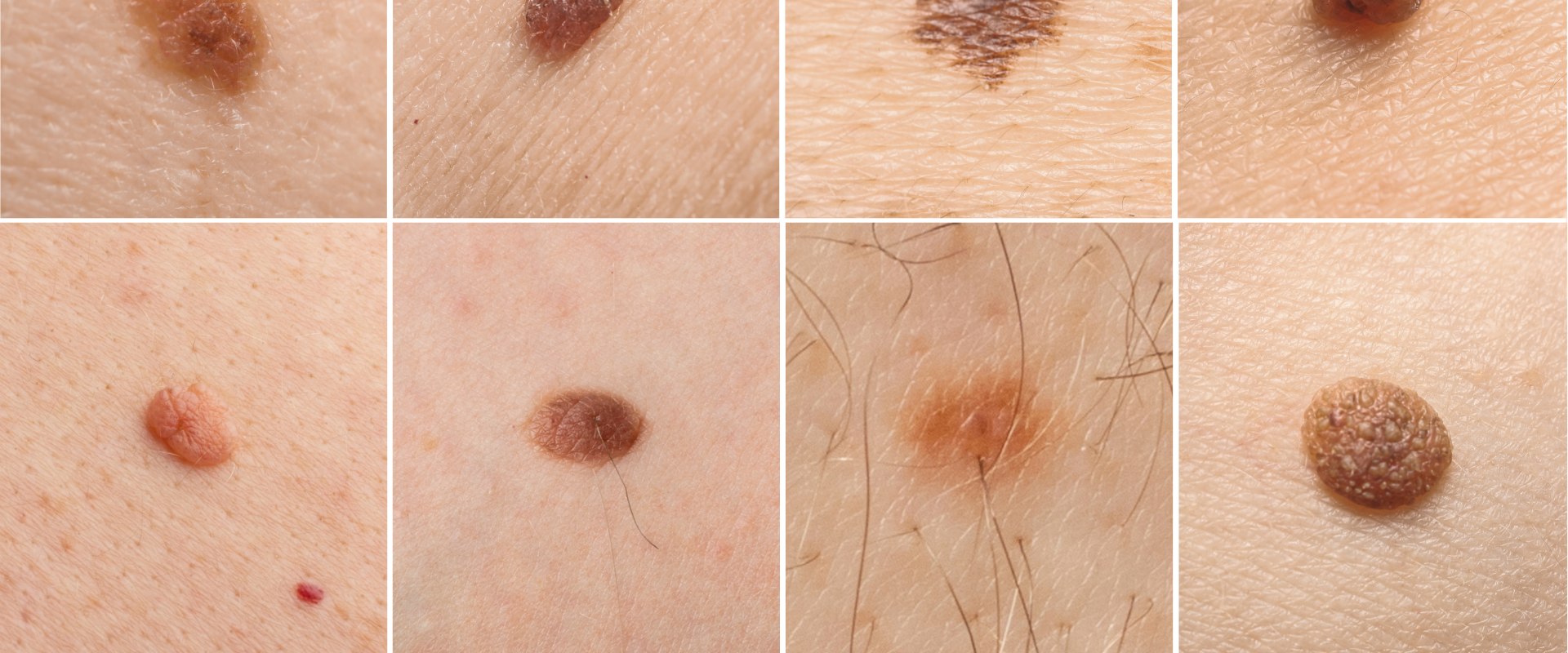 Understanding Melanoma: What You Need to Know Understanding Melanoma: What You Need to Know