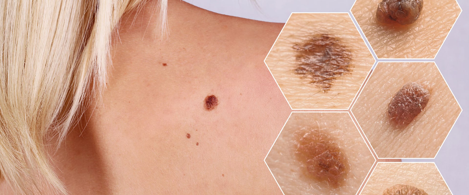 What You Need to Know About Melanoma Skin Cancer